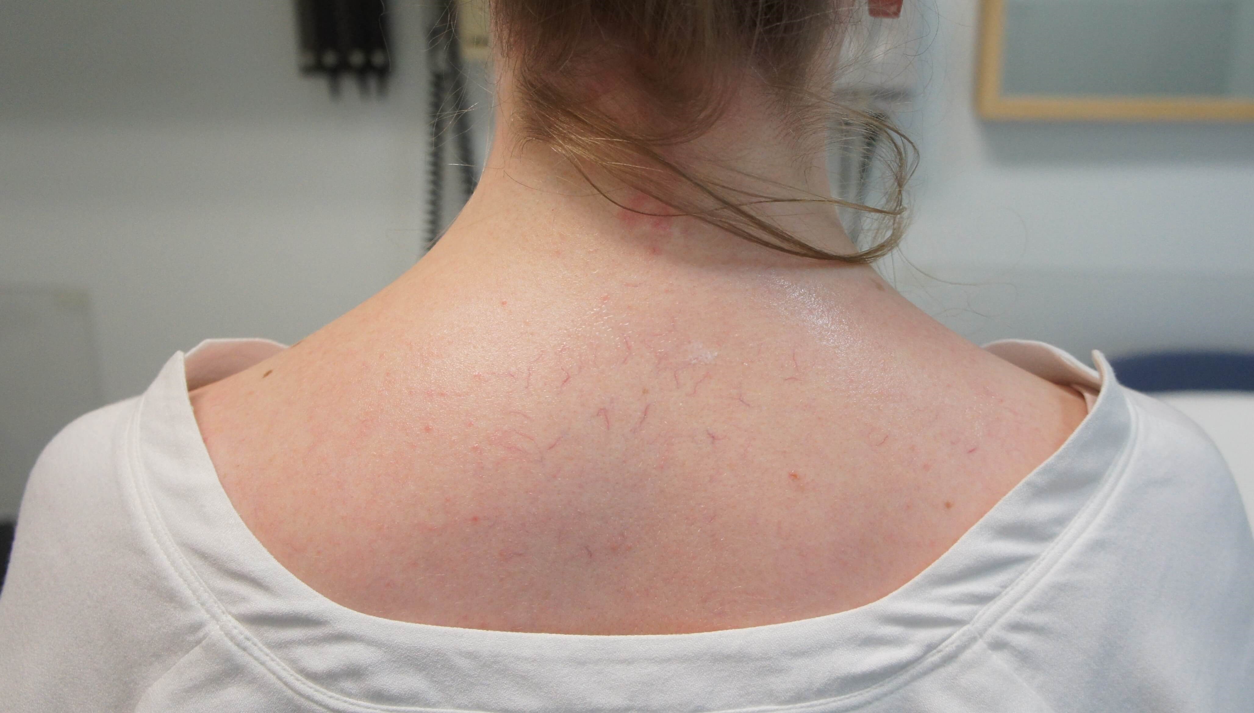 Girl With Broken Back